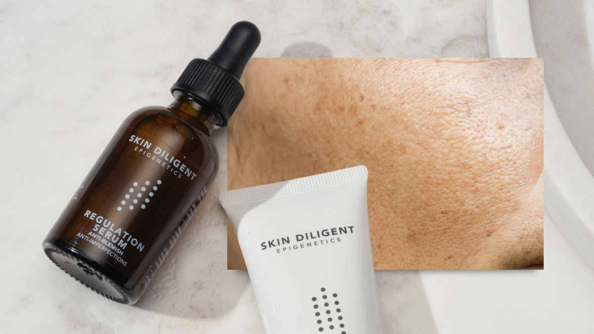Hyperpigmentation: What Causes It and Why Most Daily-Use Solutions Fai ...